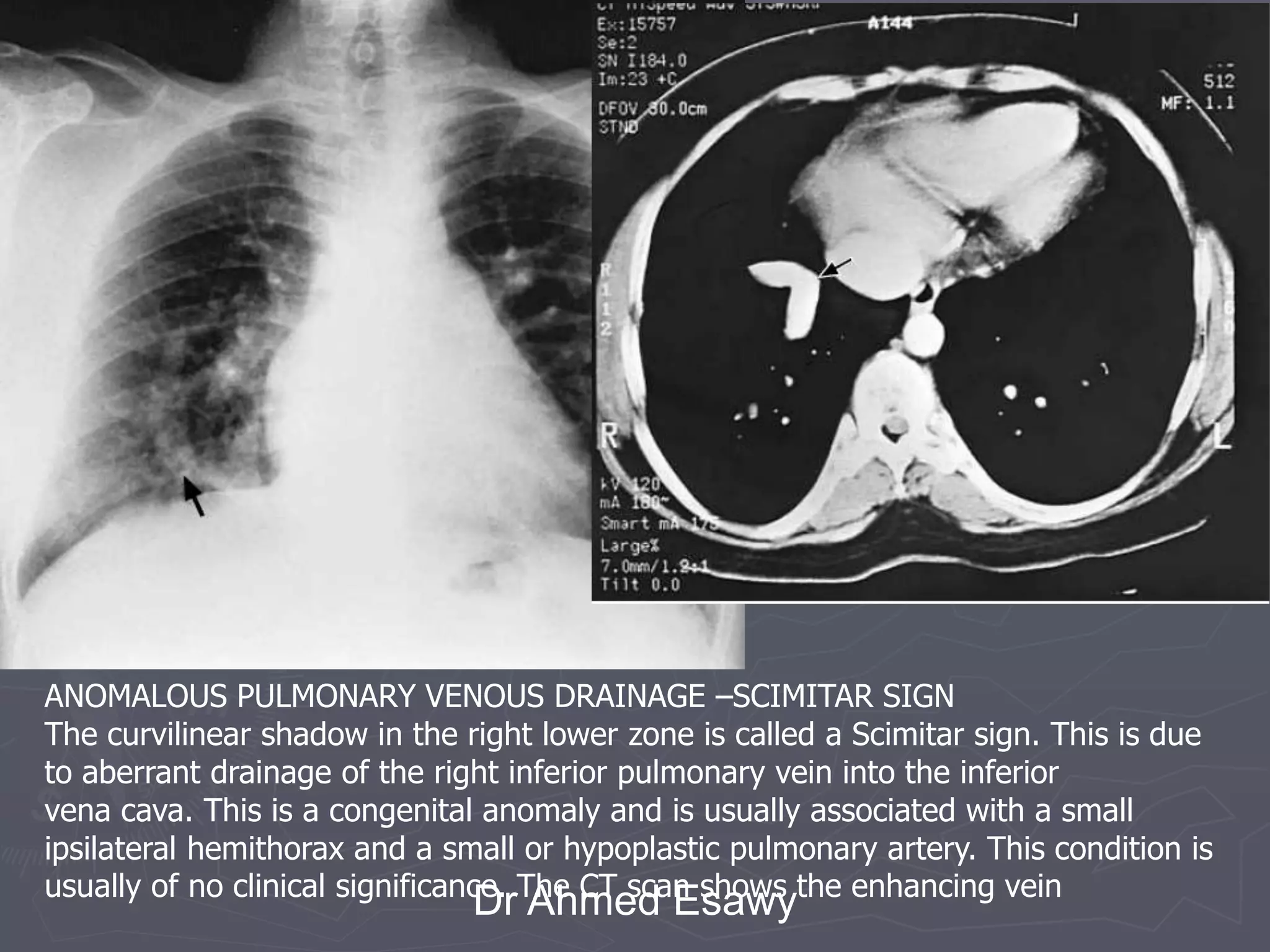 Linear lung density x ray Dr Ahmed Esawy | PDF