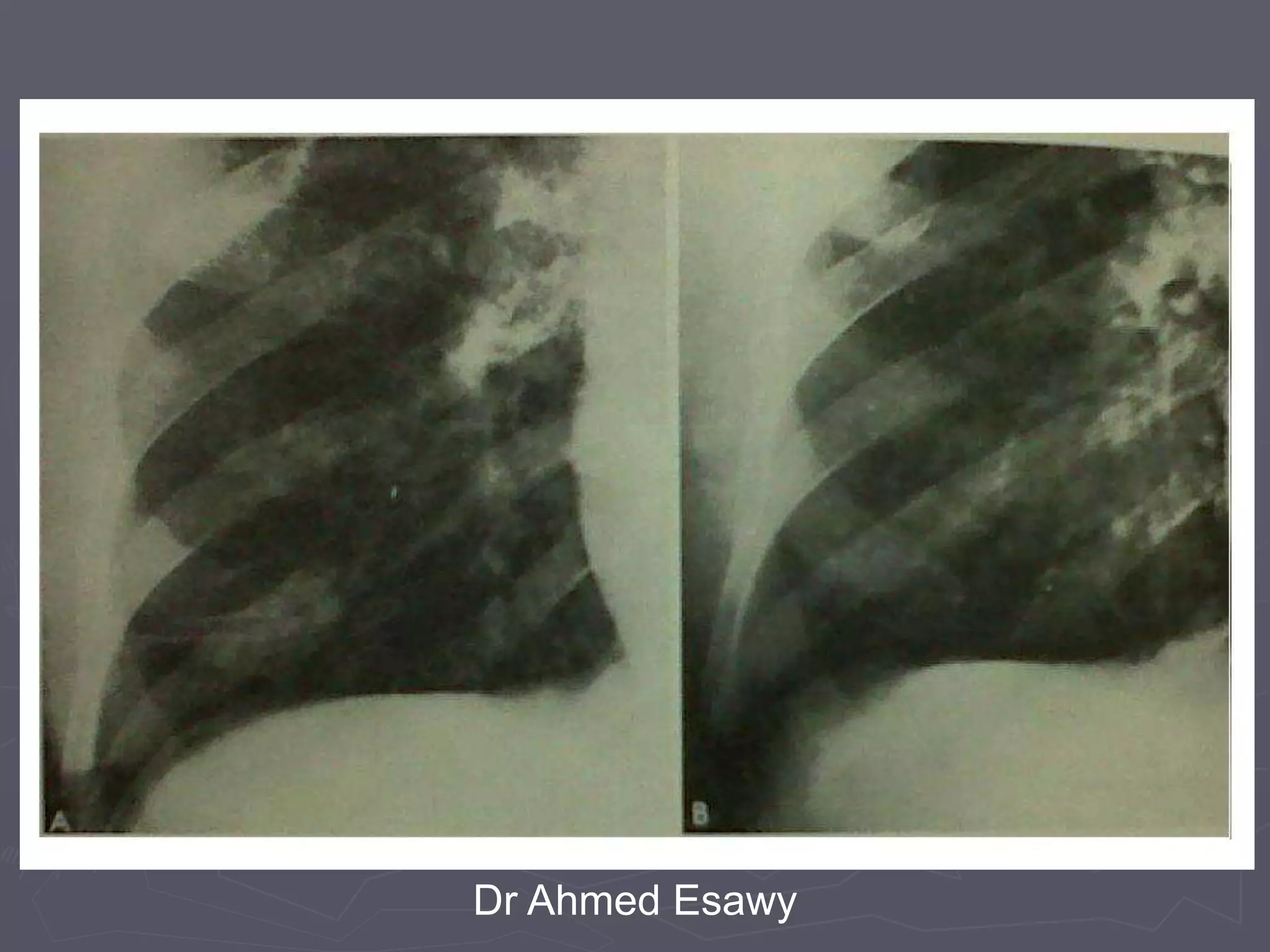 Linear lung density x ray Dr Ahmed Esawy | PDF