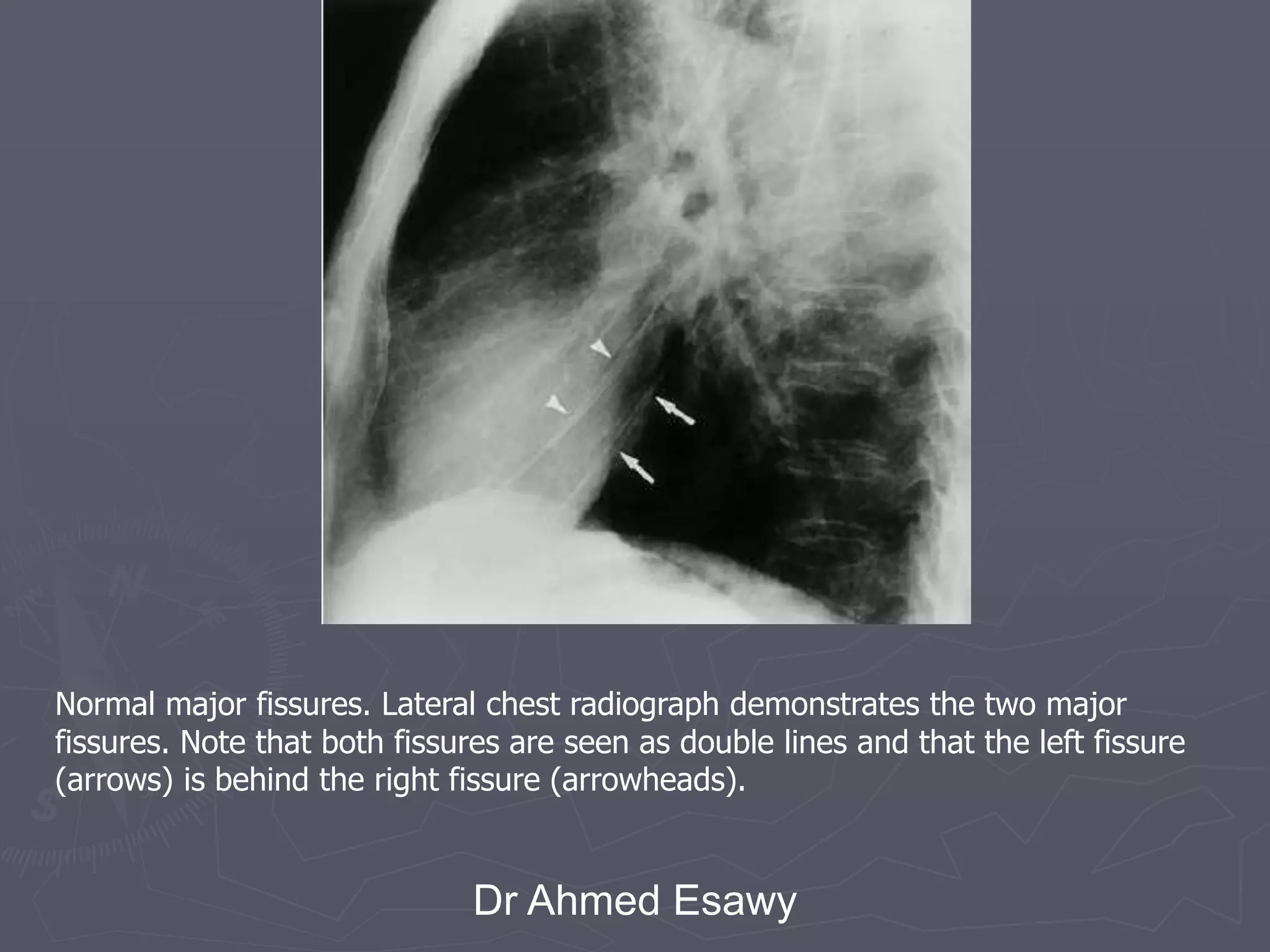 Linear lung density x ray Dr Ahmed Esawy | PDF
