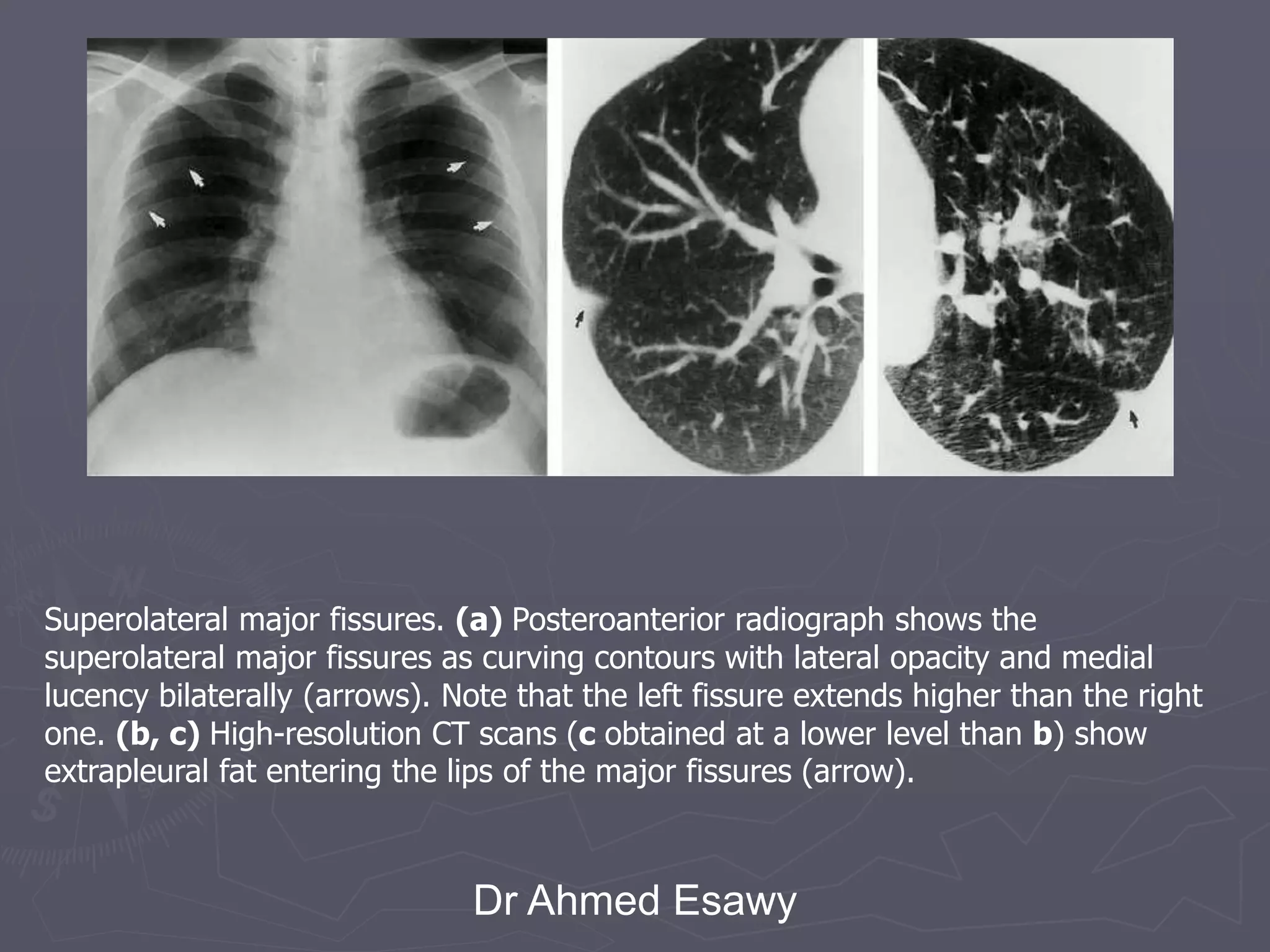 Linear lung density x ray Dr Ahmed Esawy | PDF