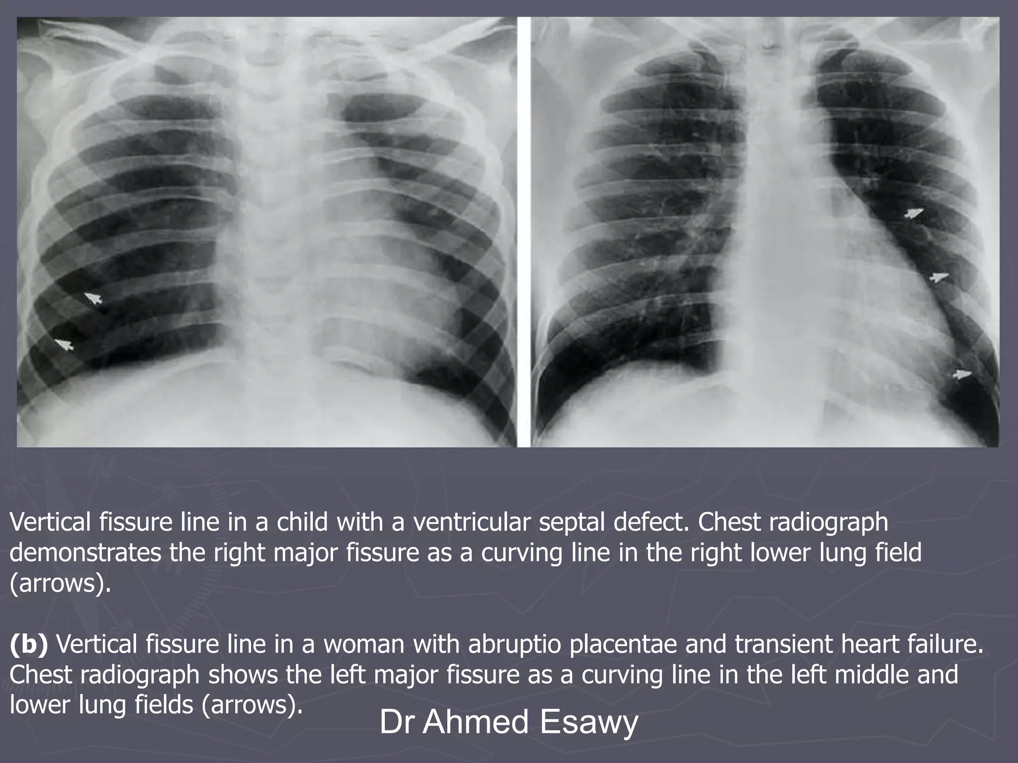 Linear lung density x ray Dr Ahmed Esawy | PDF