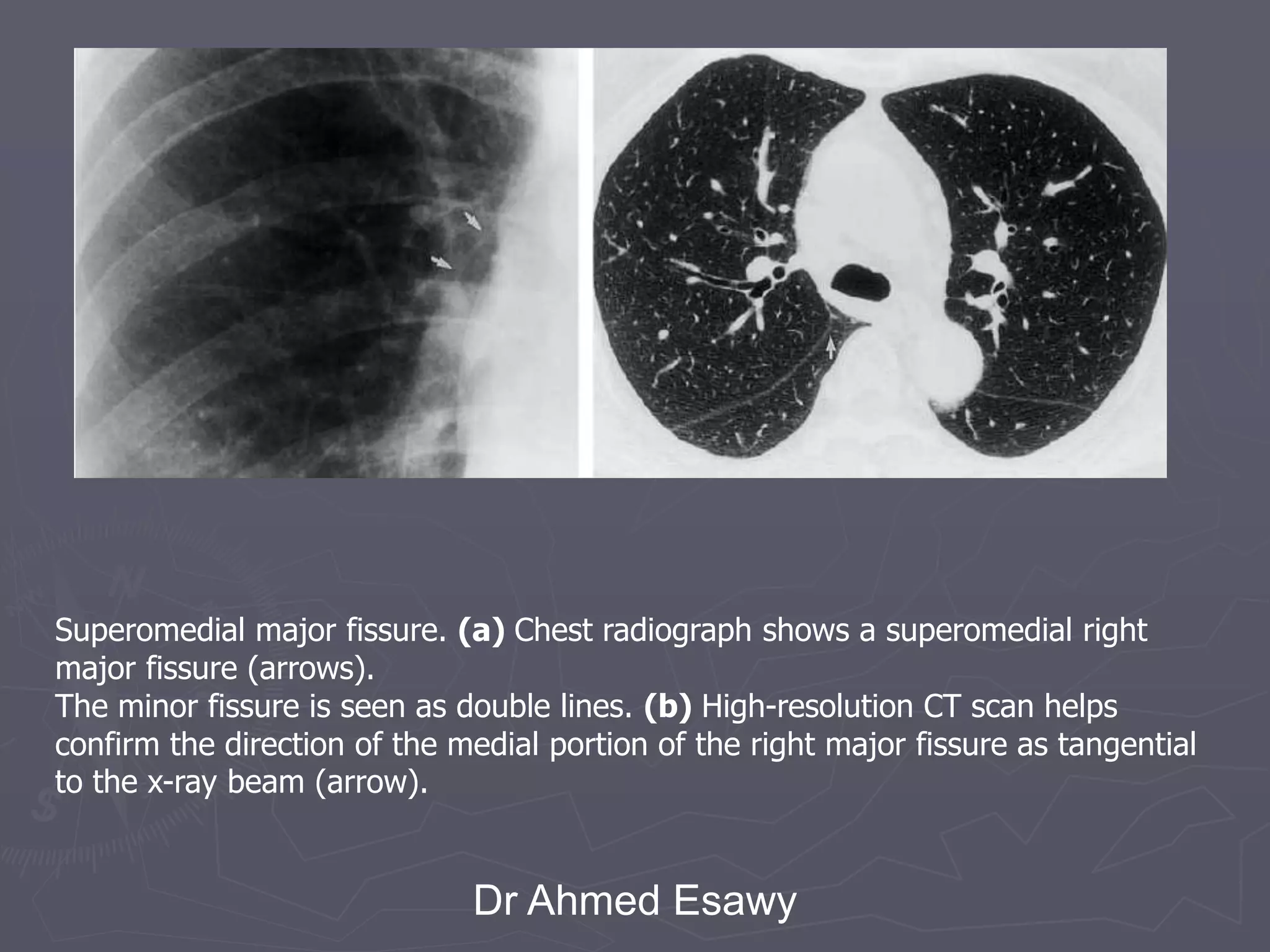 Linear lung density x ray Dr Ahmed Esawy | PDF