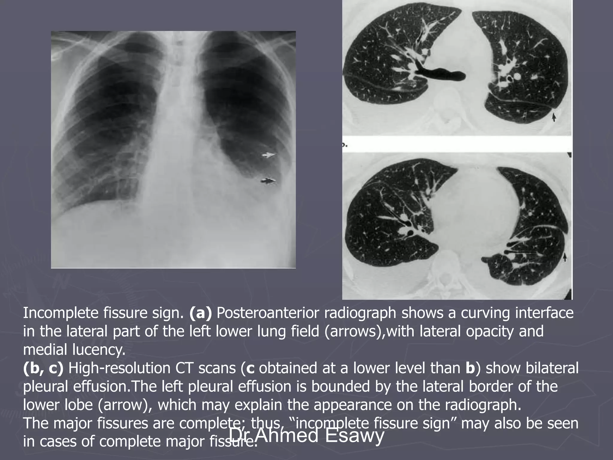 Linear lung density x ray Dr Ahmed Esawy | PDF