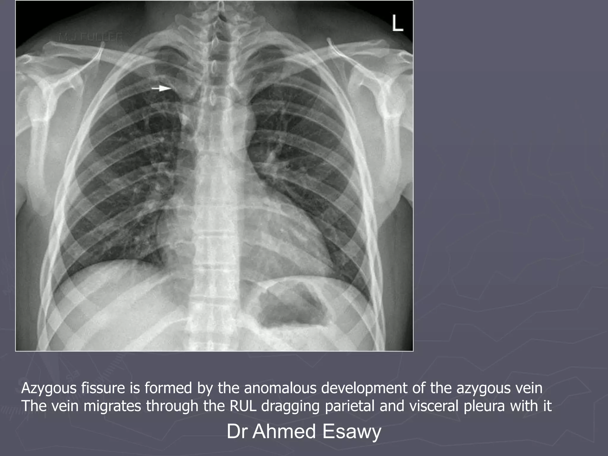 Linear lung density x ray Dr Ahmed Esawy | PDF