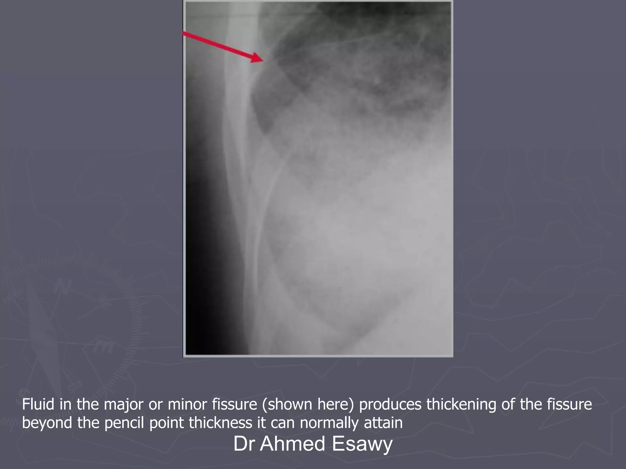 Linear lung density x ray Dr Ahmed Esawy | PDF