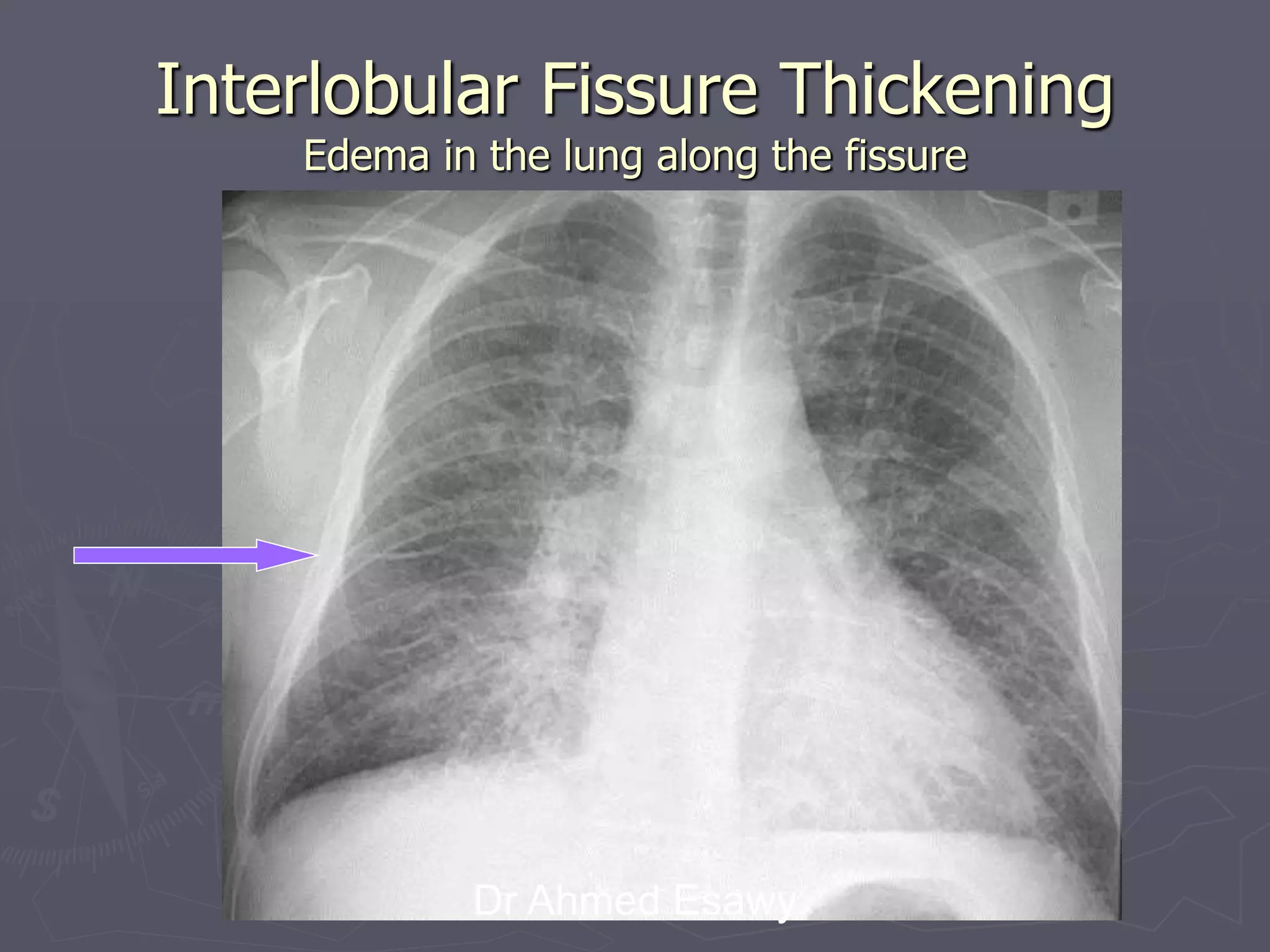 Linear lung density x ray Dr Ahmed Esawy | PDF