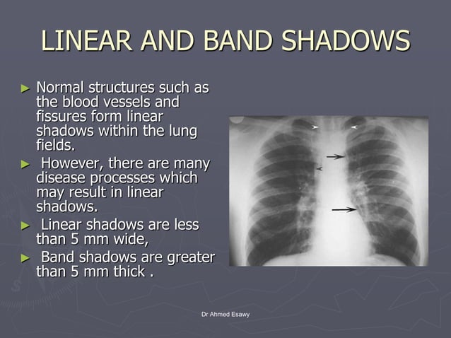 Linear lung density x ray Dr Ahmed Esawy | PDF