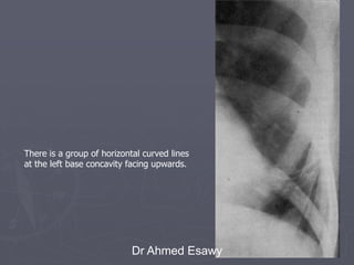 Linear lung density x ray Dr Ahmed Esawy | PDF