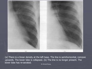 Linear lung density x ray Dr Ahmed Esawy | PDF