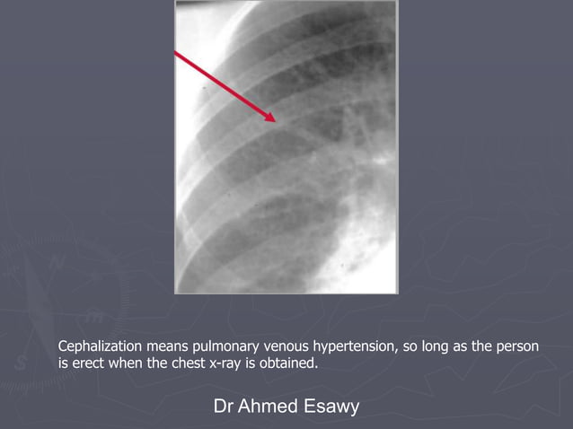 Linear lung density x ray Dr Ahmed Esawy | PDF