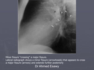 Linear lung density x ray Dr Ahmed Esawy | PDF
