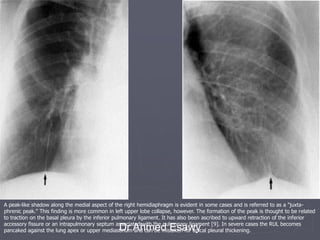 Linear lung density x ray Dr Ahmed Esawy | PDF