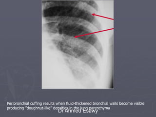 Peribronchial Cuffing