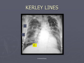 Kerley B Lines Labeled