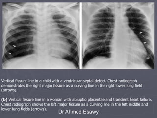 Lung Density On X Ray