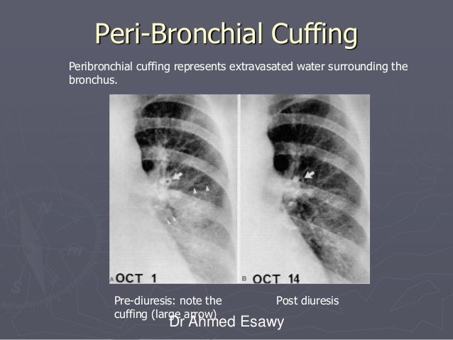 Linear lung density x ray Dr Ahmed Esawy