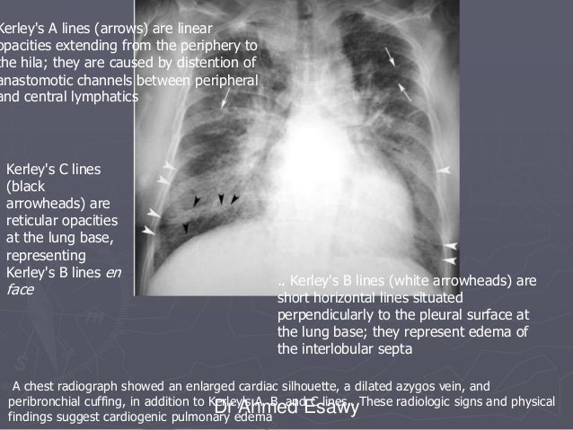 Linear lung density x ray Dr Ahmed Esawy