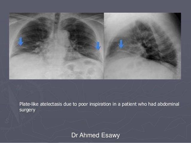Linear lung density x ray Dr Ahmed Esawy