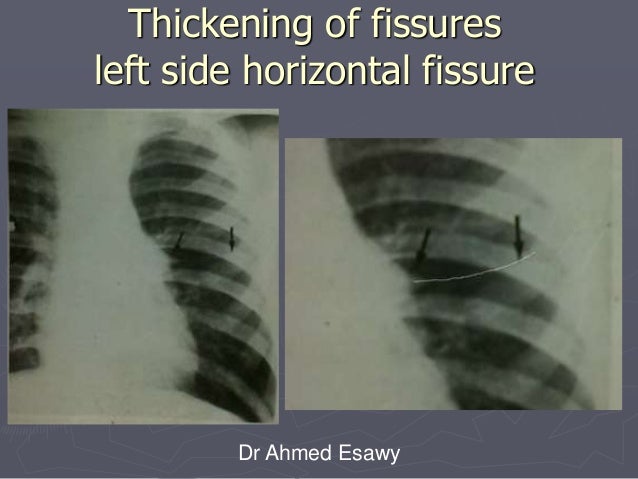 Linear lung density x ray Dr Ahmed Esawy