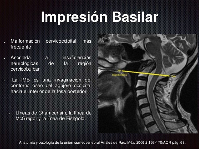 Líneas base cráneo/Línea de Wackenheim, Chamberlain, McGregor, Líne…