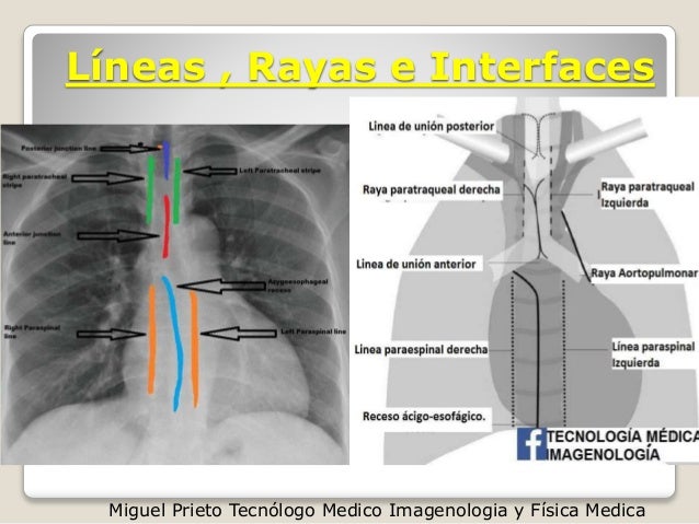 Lineas y rayas en radiografía de tórax