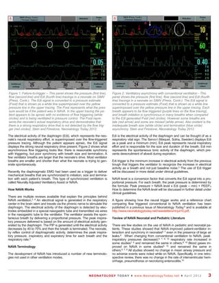Linee guida nava nel neonato | PDF