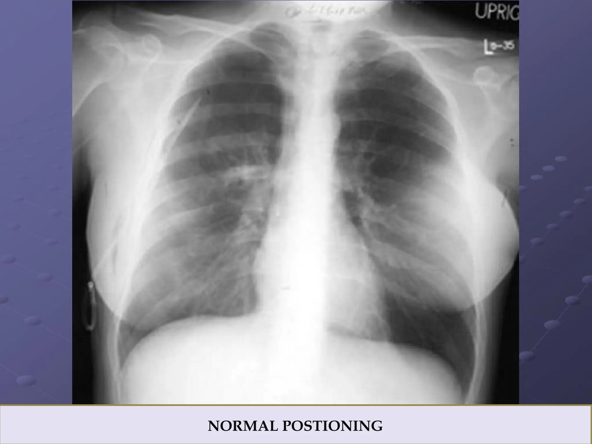 LINES AND TUBES IN HEST RADIOGRAPH .pptx