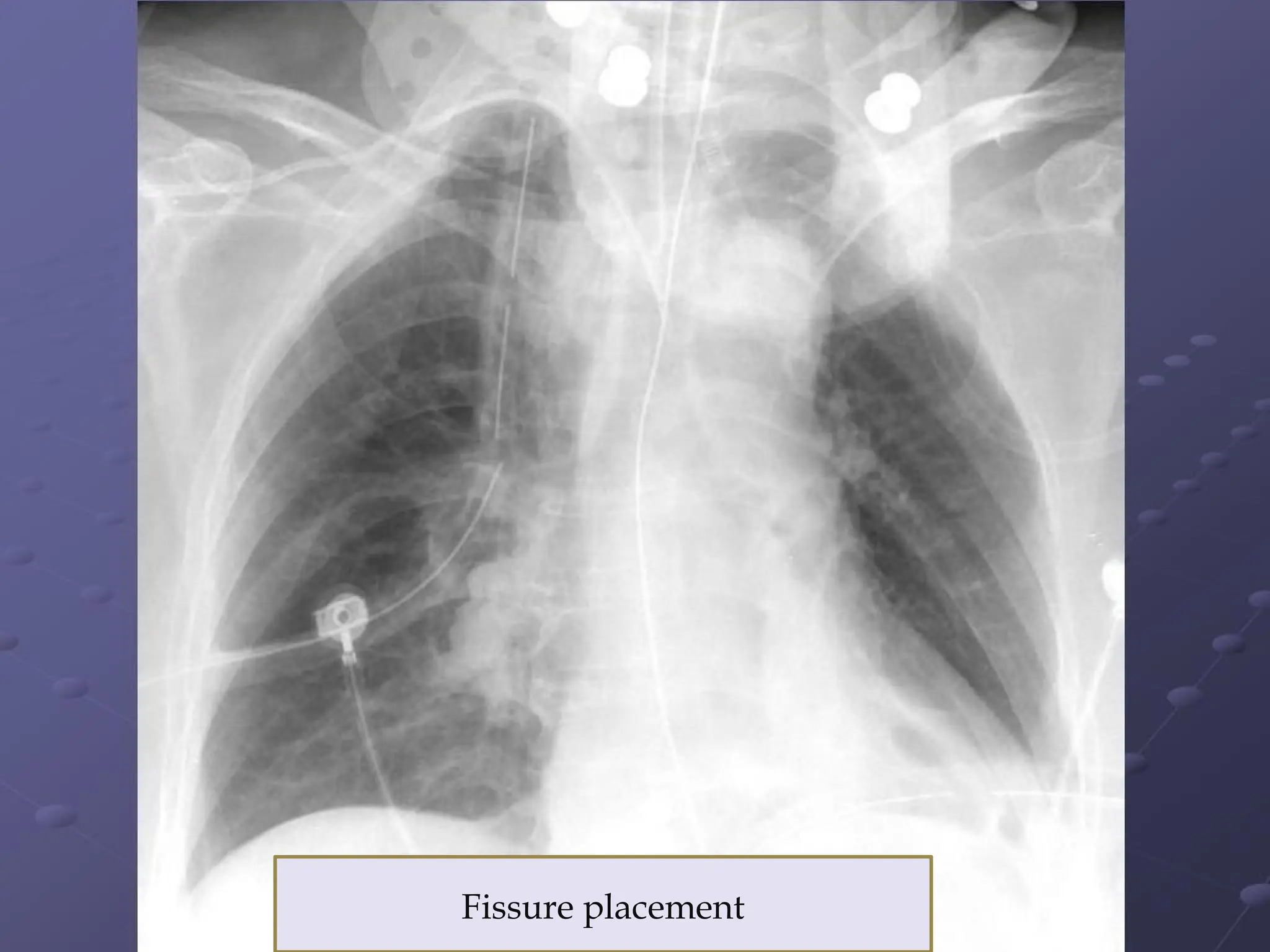 LINES AND TUBES IN HEST RADIOGRAPH .pptx