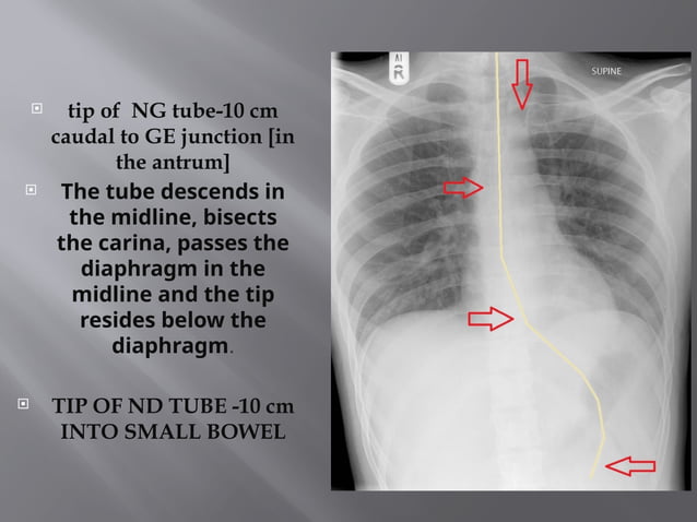 LINES AND TUBES IN HEST RADIOGRAPH .pptx