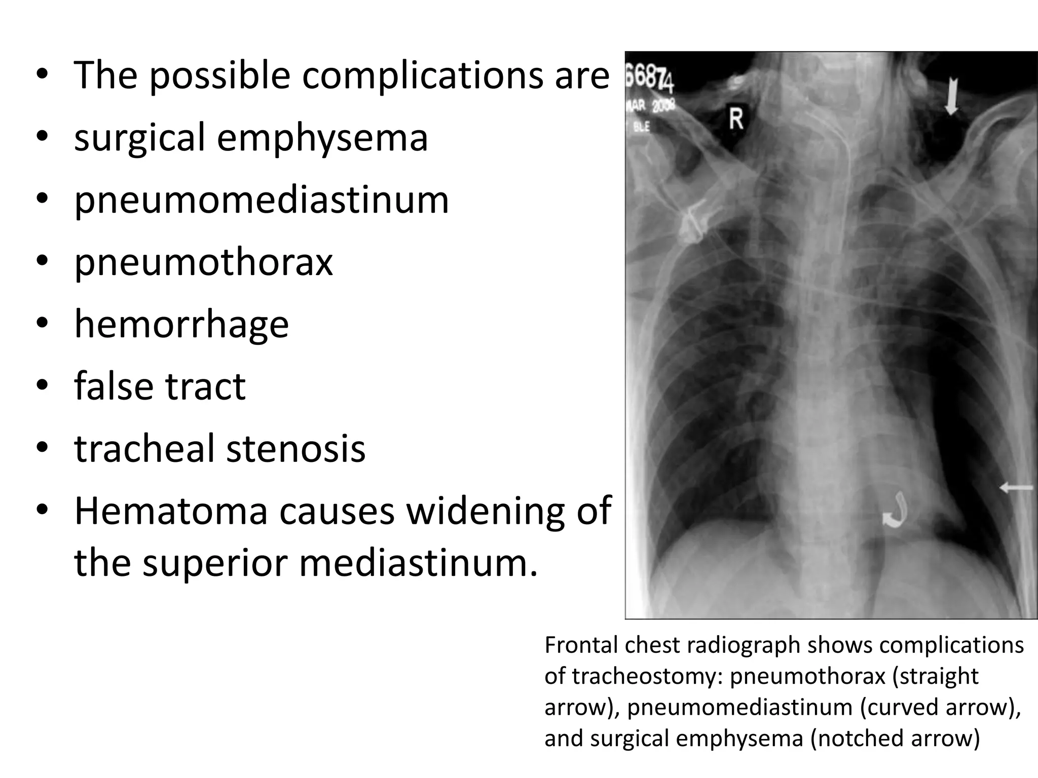 Lines and tubes in xray | PPTX