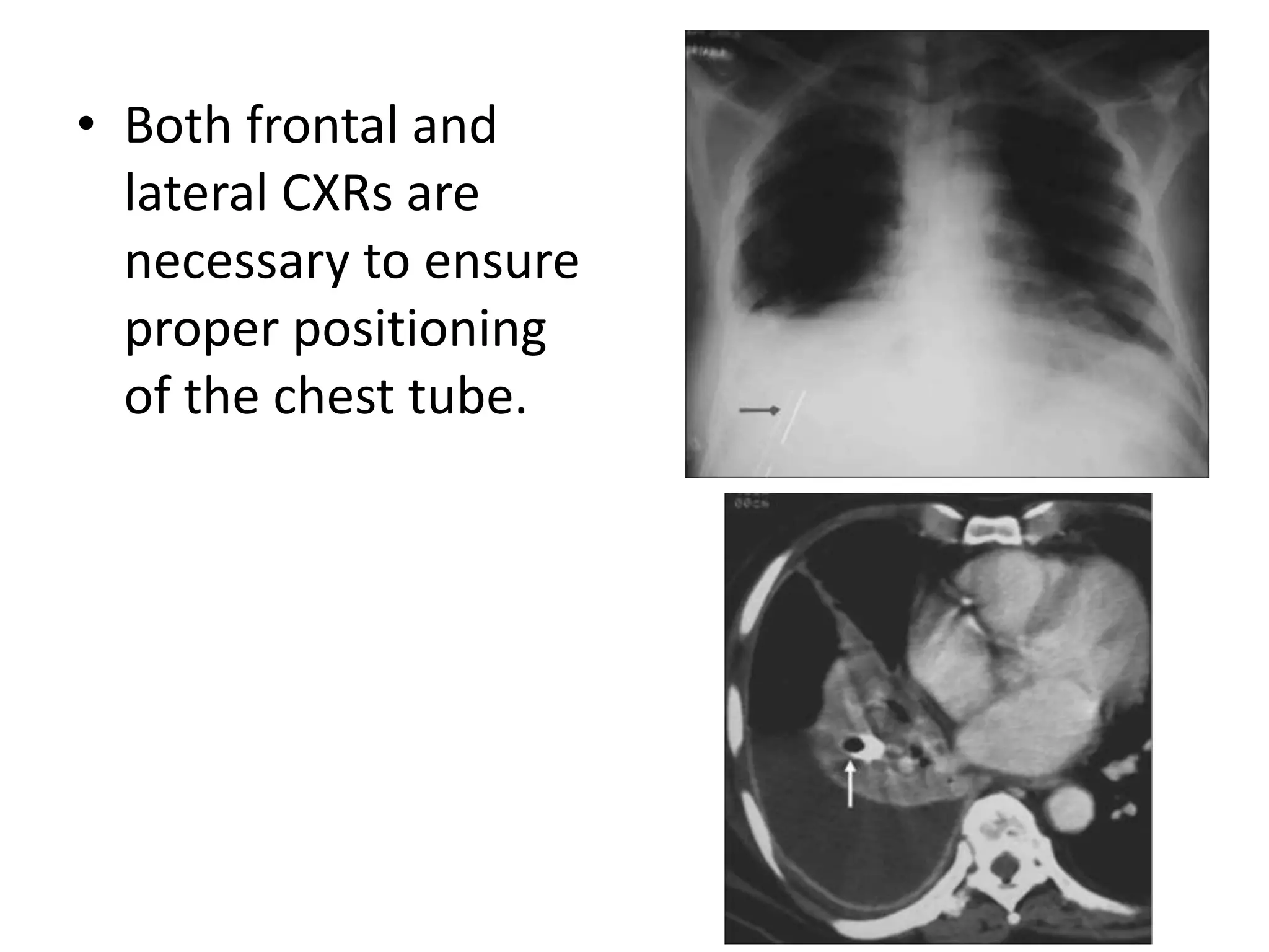 Lines and tubes in xray | PPTX