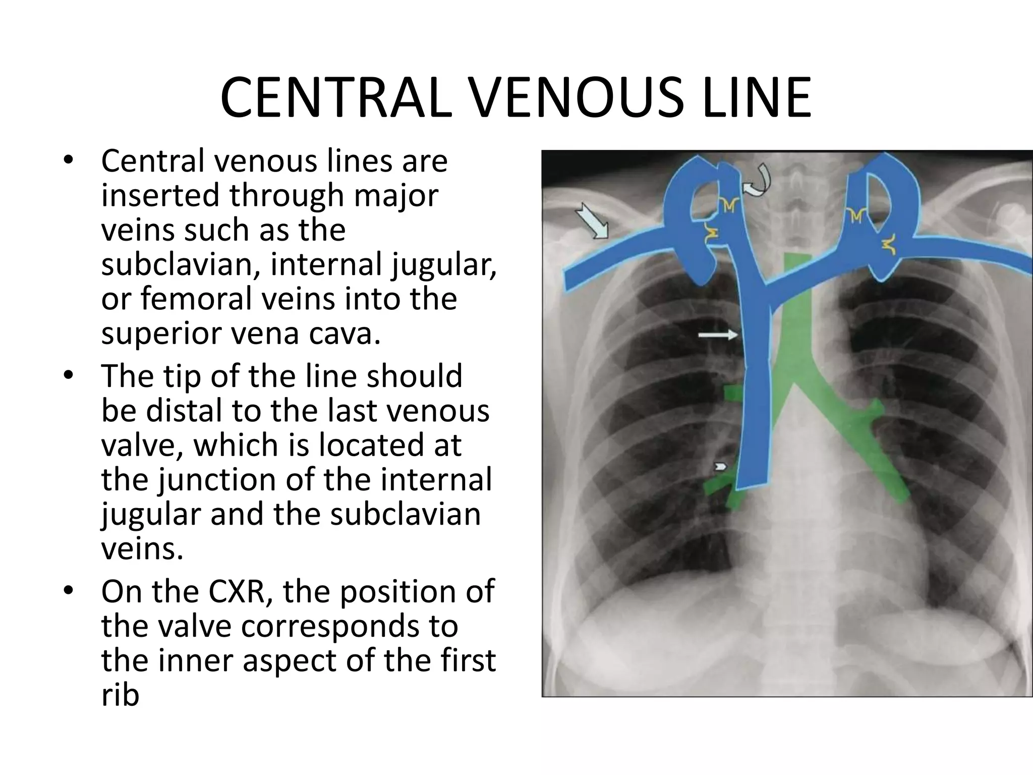 Lines and tubes in xray | PPTX