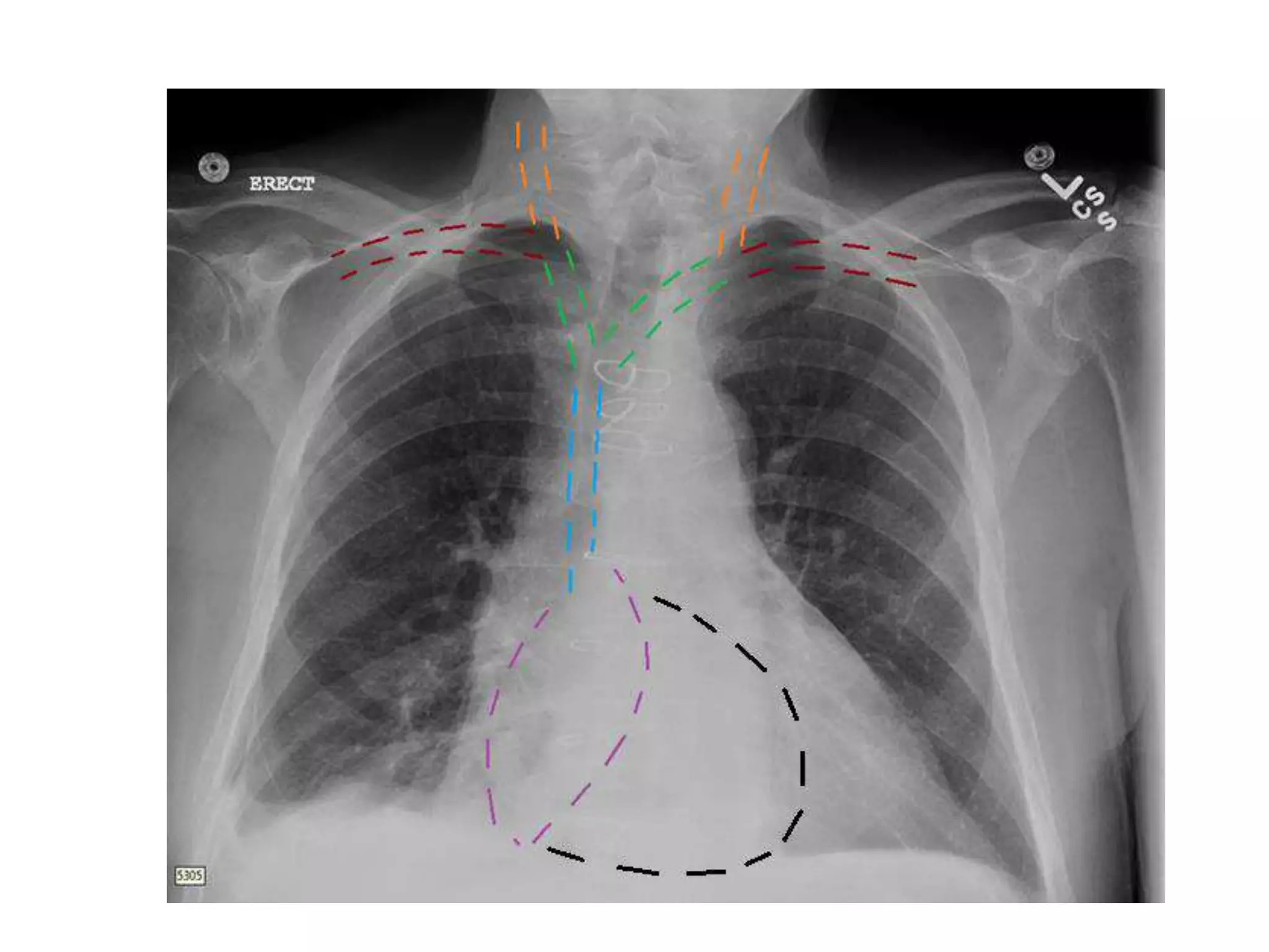 Lines and tubes in xray | PPTX