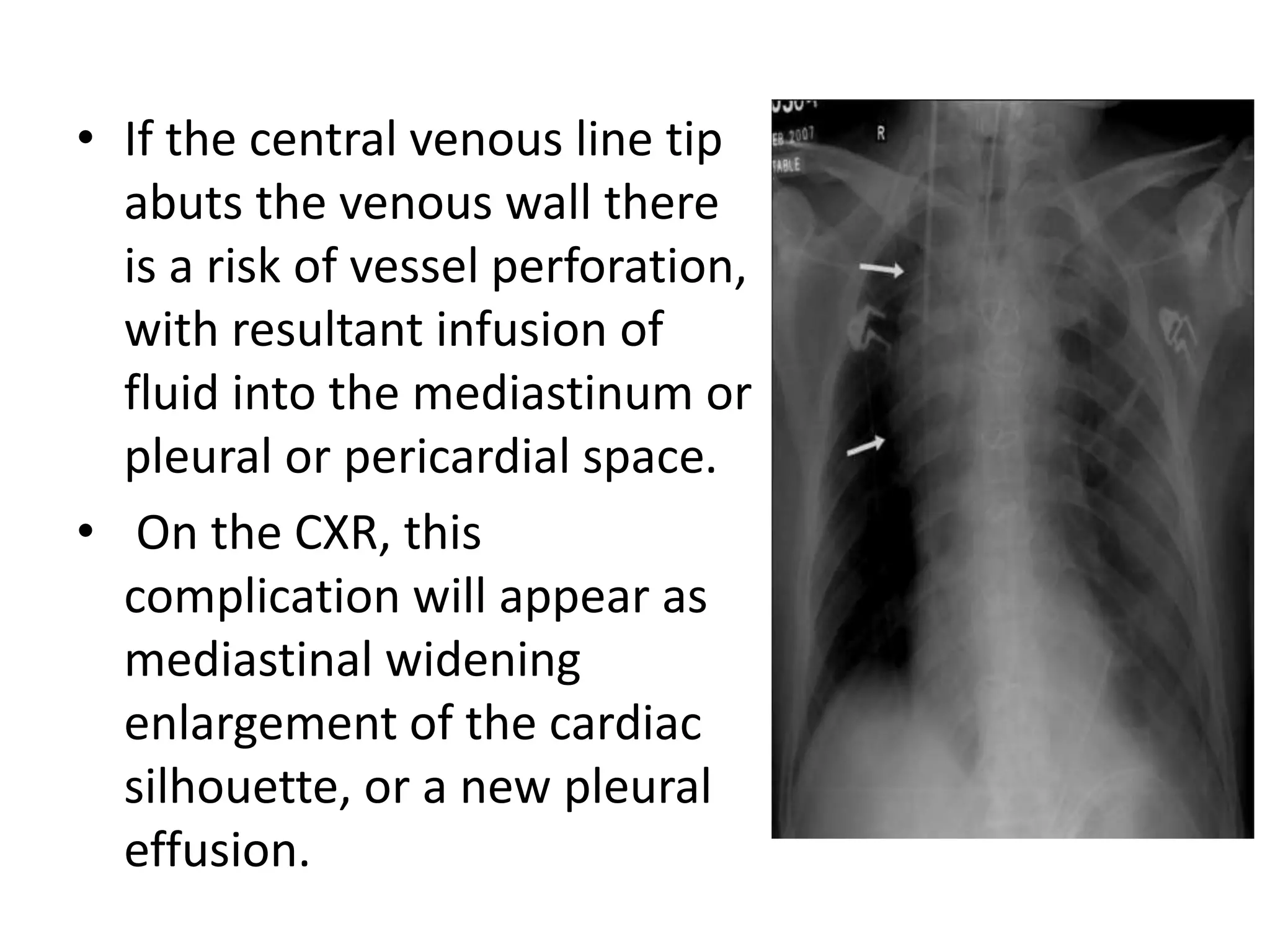 Lines and tubes in xray | PPTX