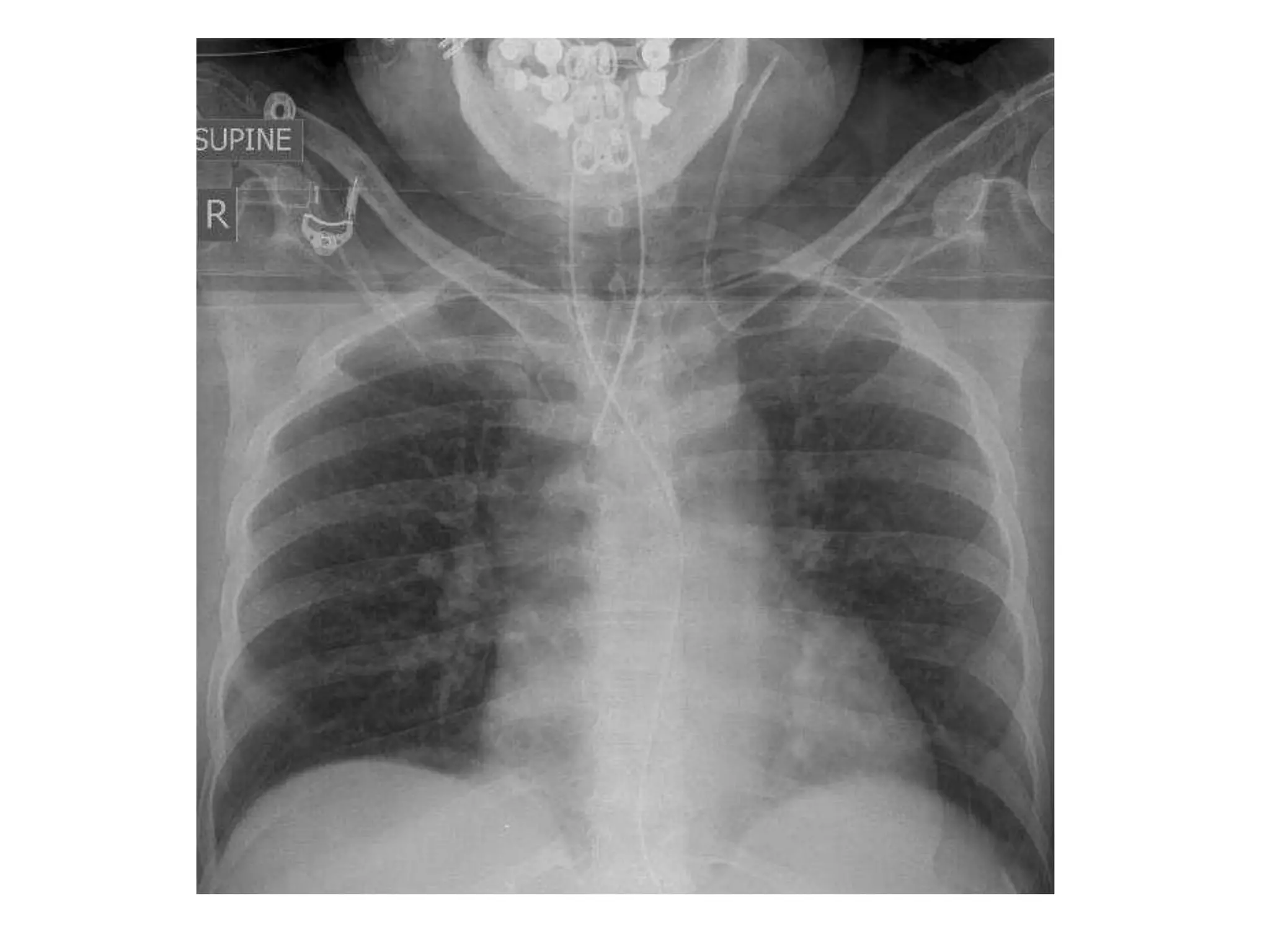 Lines and tubes in xray | PPTX