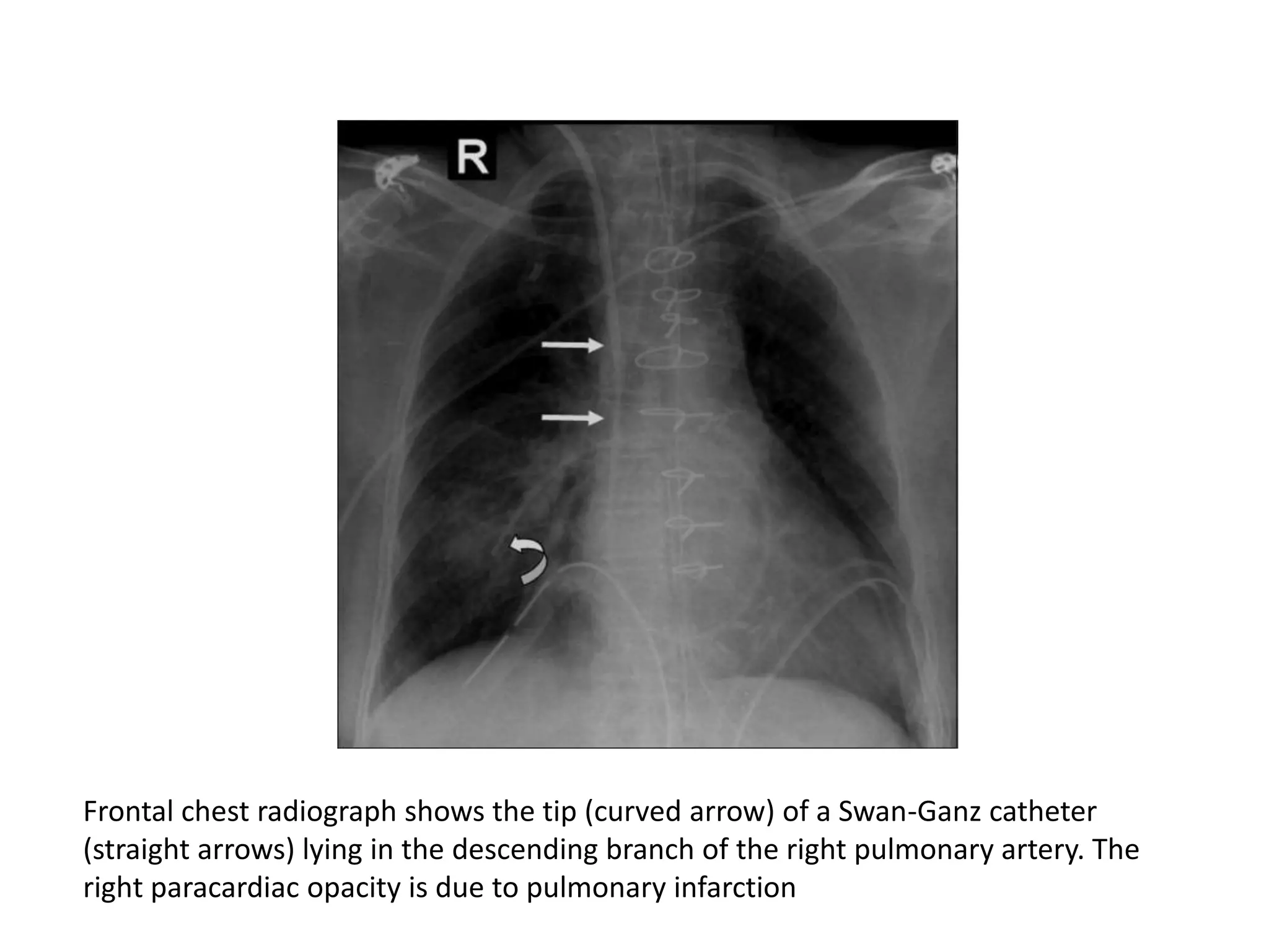 Lines and tubes in xray | PPTX
