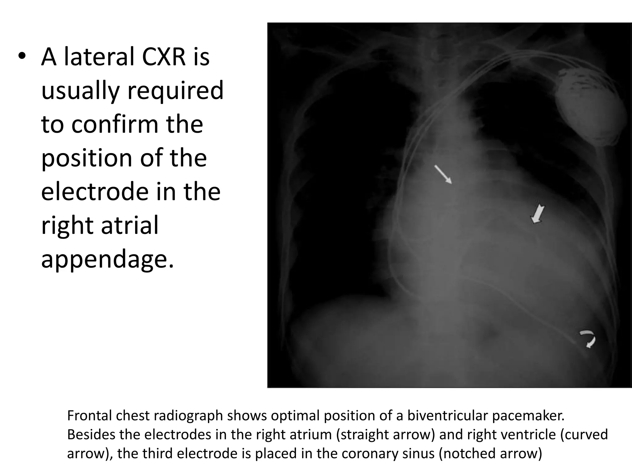 Lines and tubes in xray | PPTX