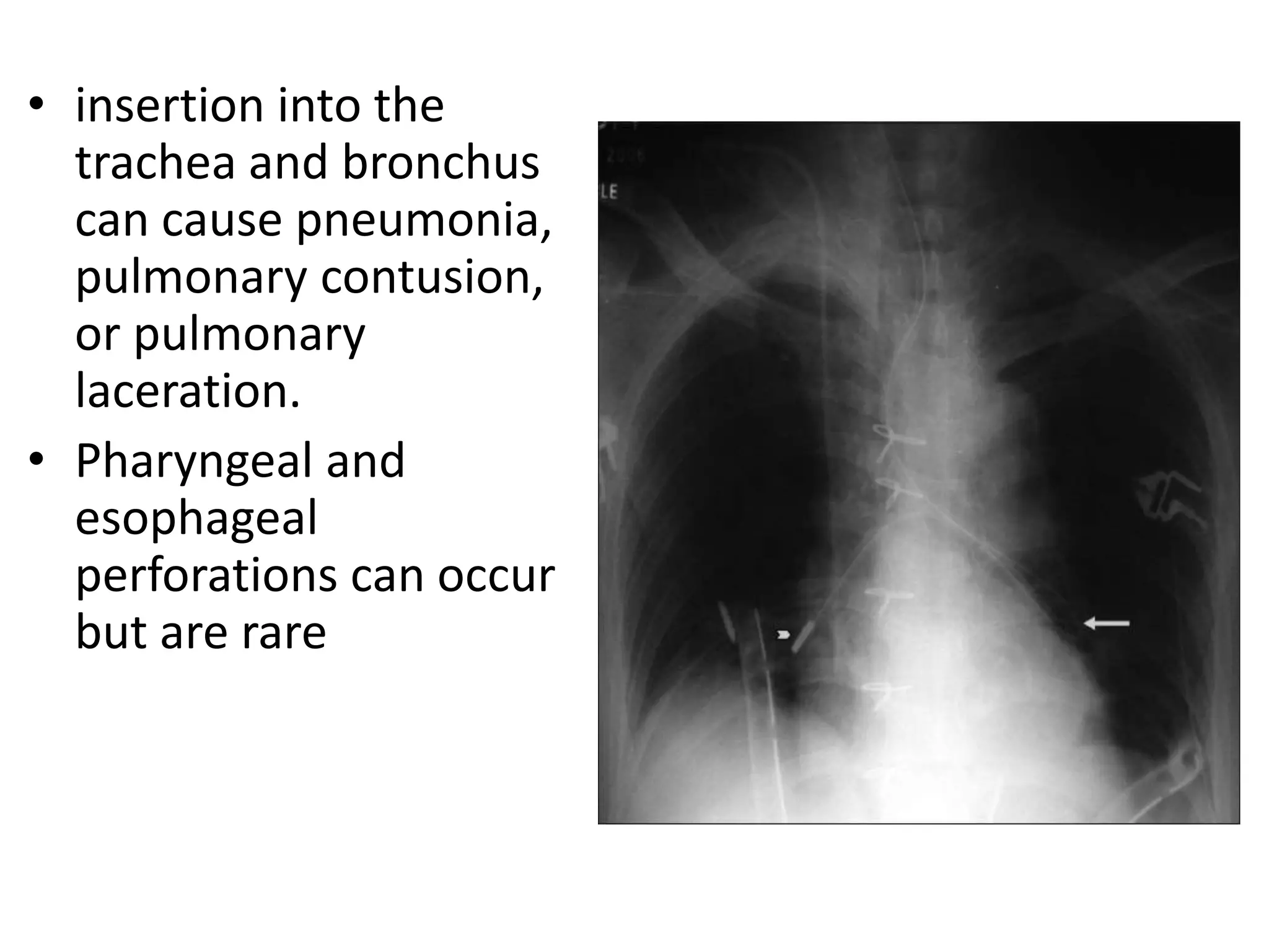 Lines and tubes in xray | PPTX