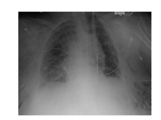 Lines and tubes in xray | PPTX