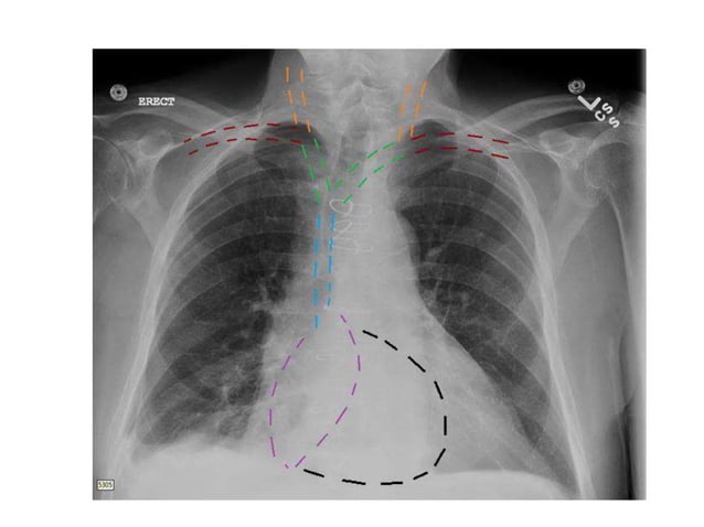 Lines and tubes in xray | PPTX | Heart and Cardiovascular Diseases ...