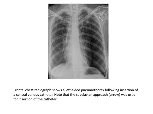 Lines and tubes in xray | PPTX | Heart and Cardiovascular Diseases ...
