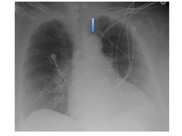 Lines and tubes in xray | PPTX | Heart and Cardiovascular Diseases ...