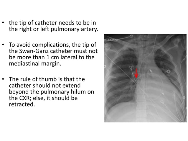 Lines and tubes in xray | PPTX | Heart and Cardiovascular Diseases ...