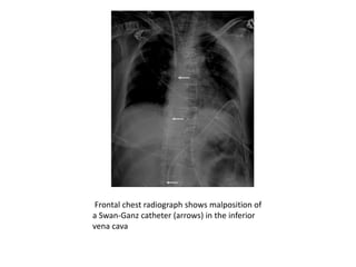 Lines and tubes in xray | PPTX