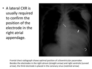 Lines and tubes in xray | PPTX
