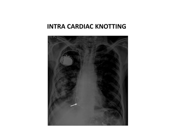 Lines and tubes in xray | PPTX | Heart and Cardiovascular Diseases ...