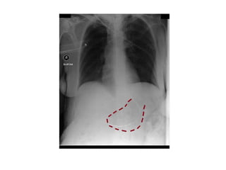 Lines and tubes in xray | PPTX