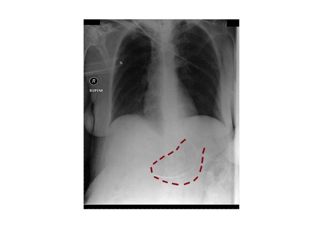 Lines and tubes in xray | PPTX | Heart and Cardiovascular Diseases ...