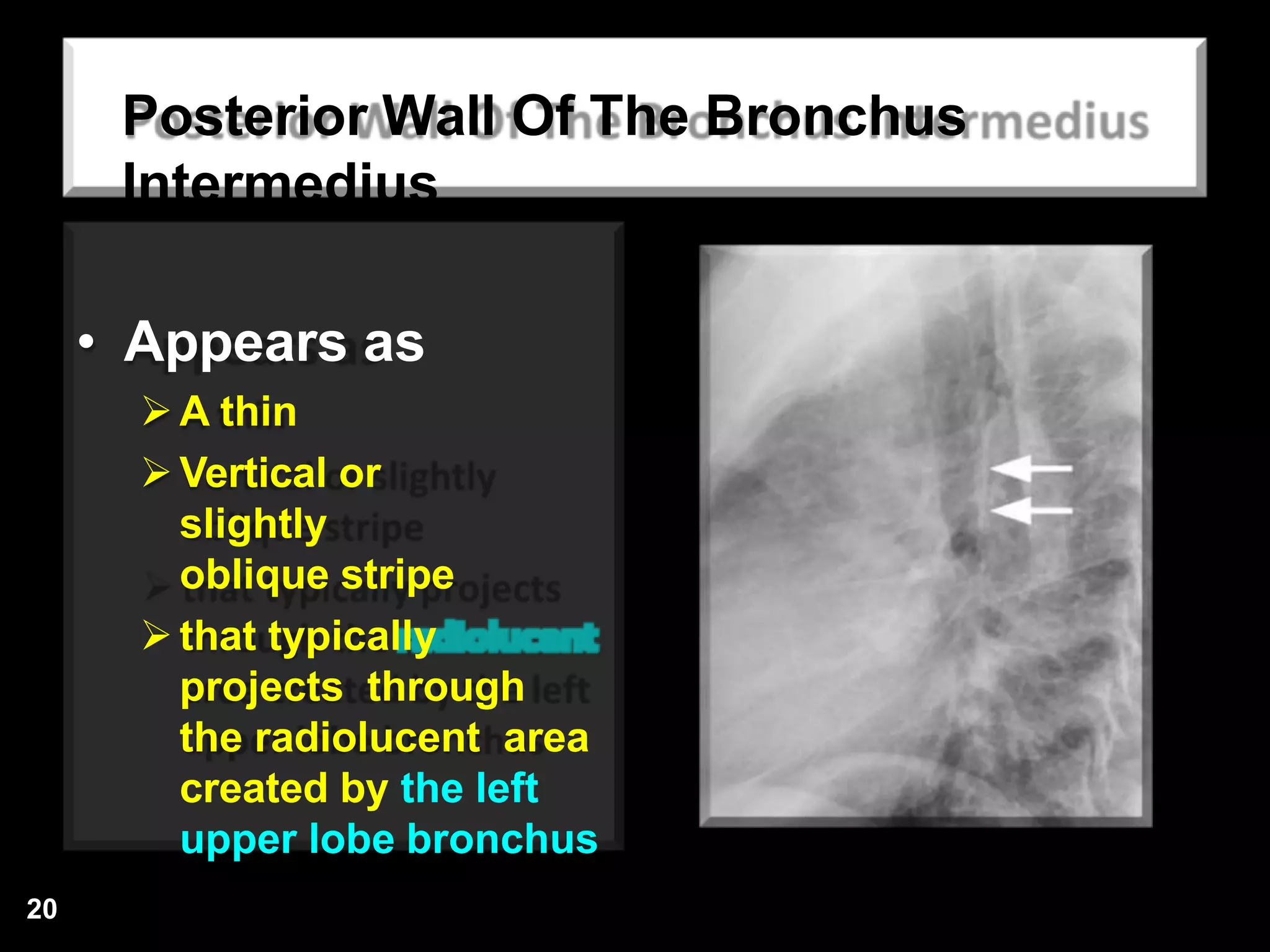 linesmediastinalstripes-01-101126132247-phpapp01.pptx