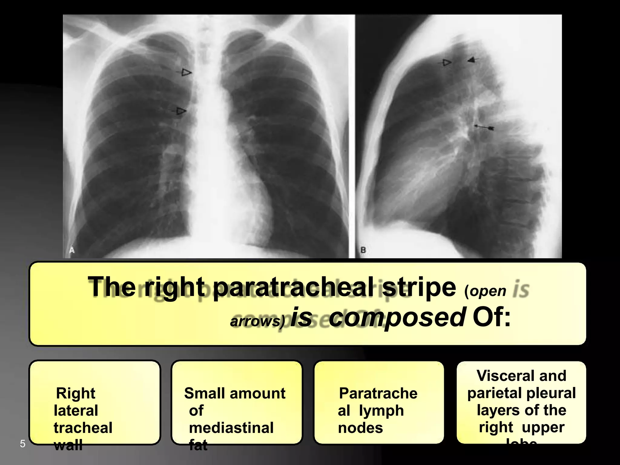 linesmediastinalstripes-01-101126132247-phpapp01.pptx
